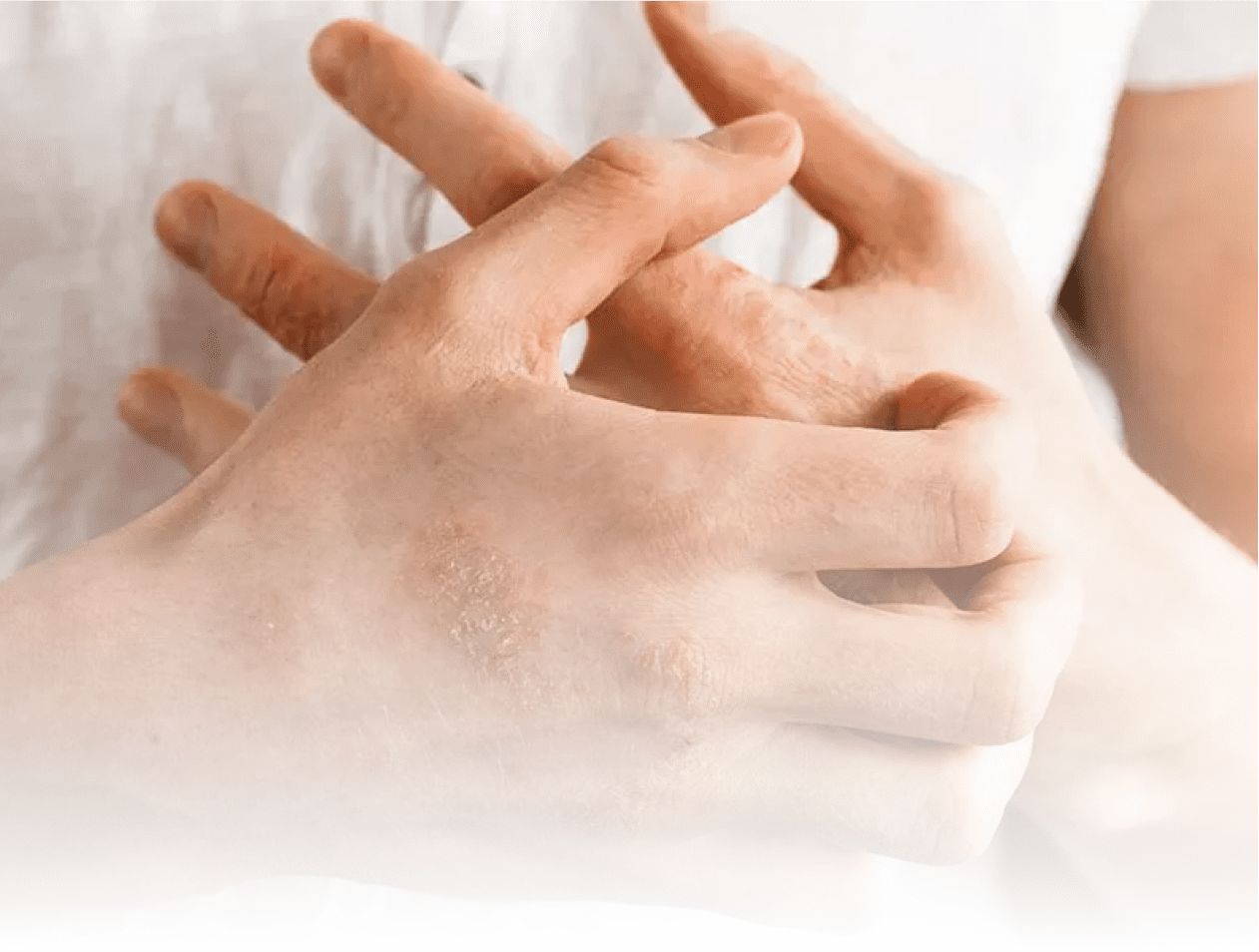 Eczema Treatment Socal Skin And Surgery